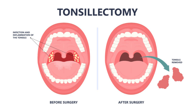What is the Worst Day of the Recovery of Tonsillectomy For a Child? - Maryland ENT
