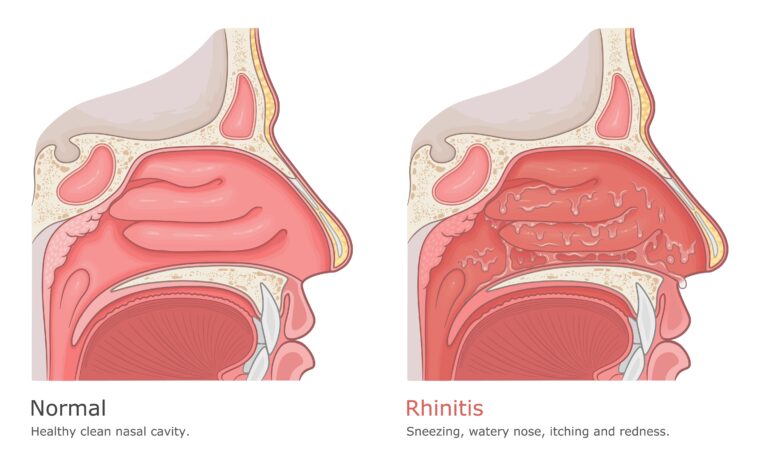 Is Sinusitis Always a Chronic Condition? - Maryland ENT