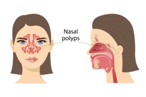 7 Signs You May Have Nasal Polyps - Maryland ENT